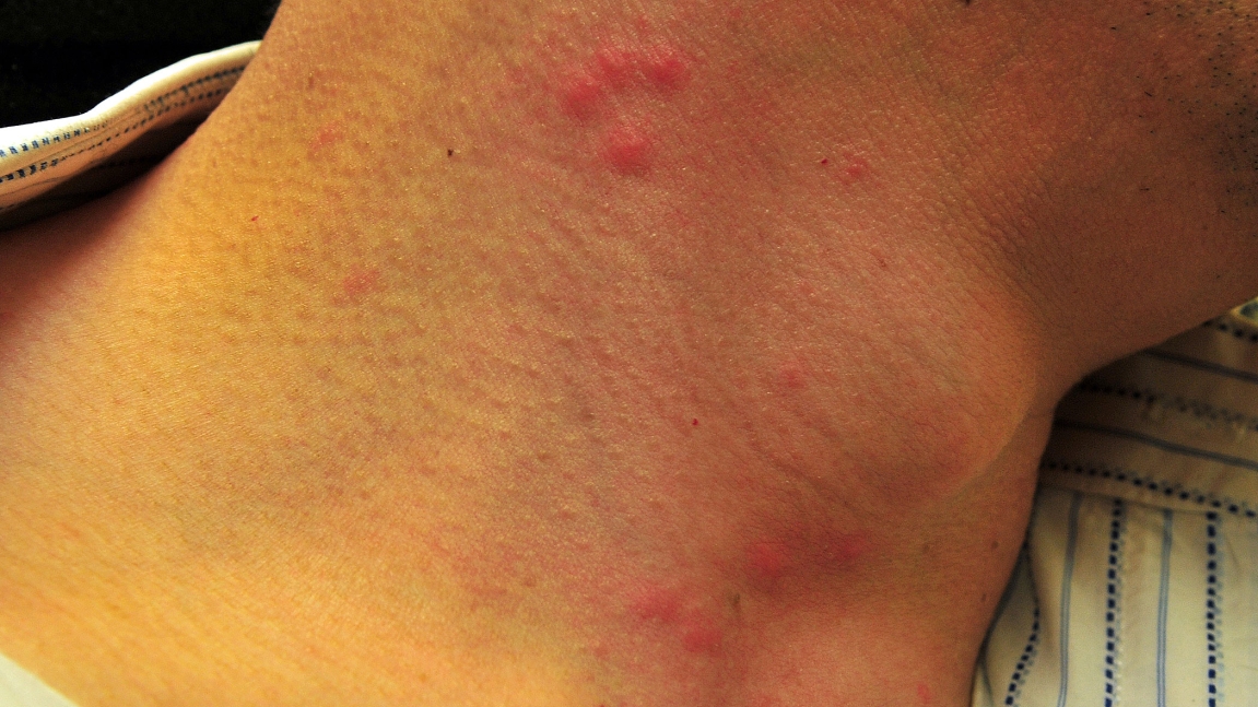 bed bug marks